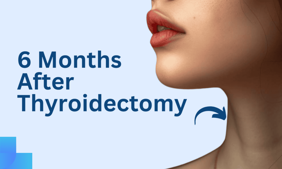 6 Months After Thyroidectomy | Dr. Devendra Chaukar