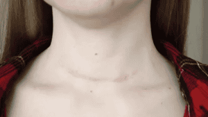 Thyroidectomy Scar After 2 Weeks | Dr Devendra Chaukar