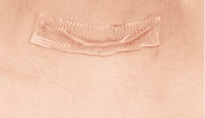 Thyroidectomy Scar After 2 Weeks | Dr Devendra Chaukar