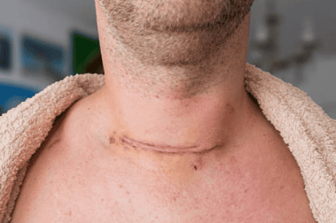 Swelling After Thyroidectomy | Dr. Devendra Chaukar