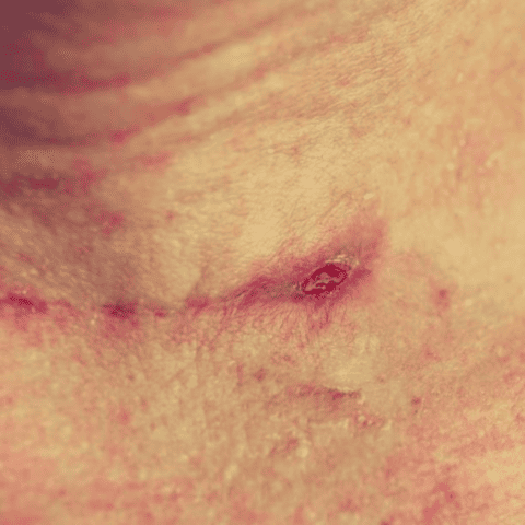Thyroidectomy Scar After 1 Week | Dr. Devendra Chaukar